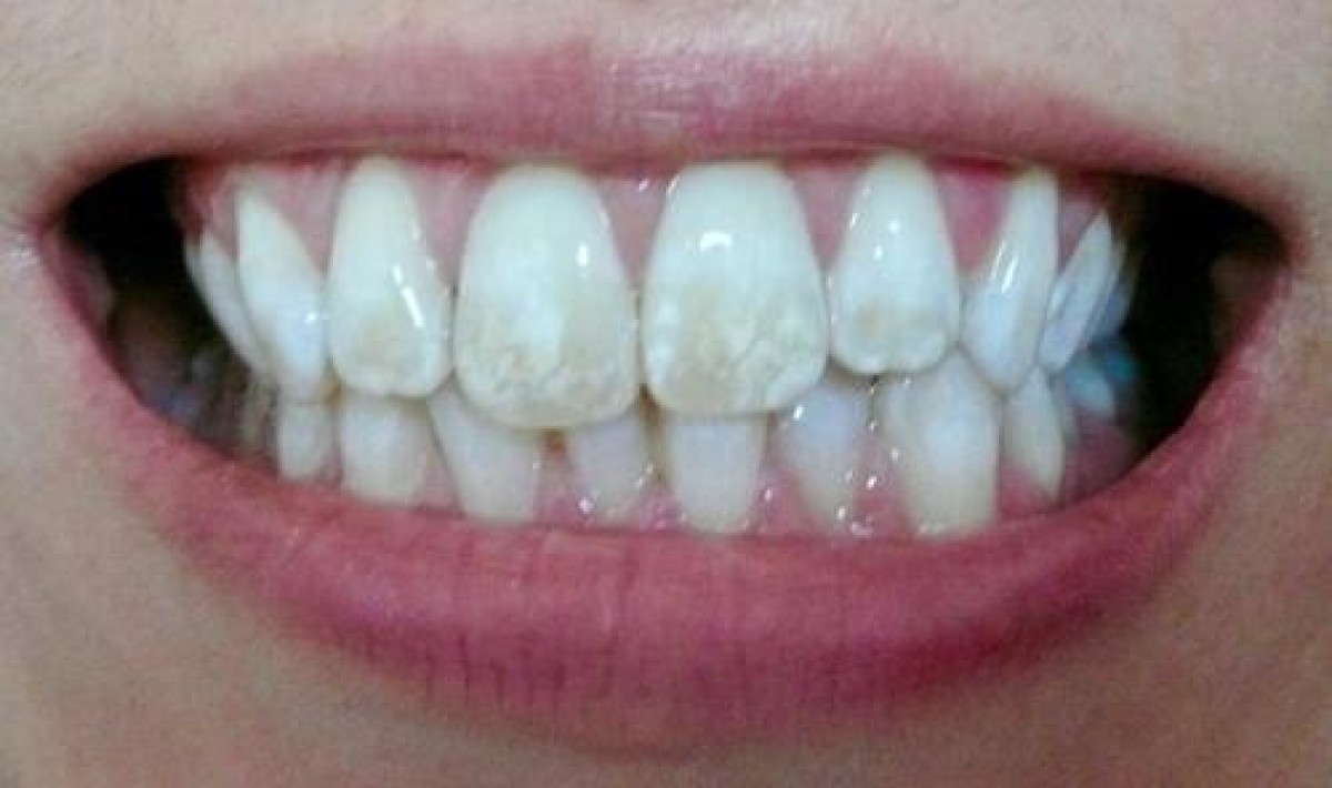 Which Therapy Is More Effective For The Treatment Of Fluorosis Which Therapy Is More Effective For The Treatment Of Fluorosis