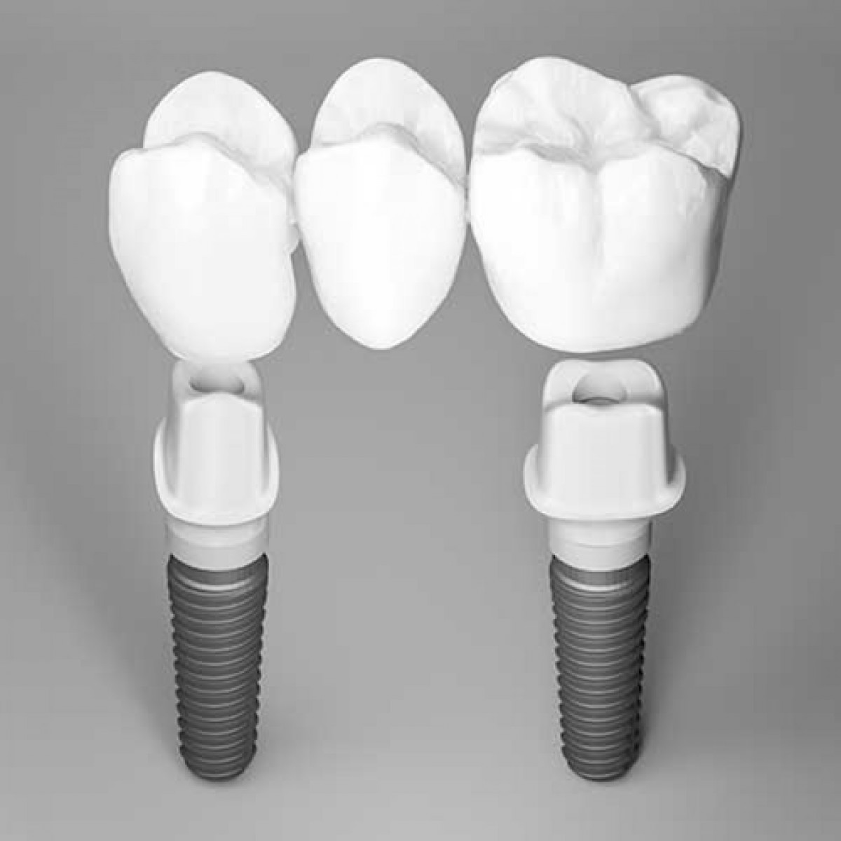 Rehabilitation of partial edentulism with 3 missing elements. What is ...