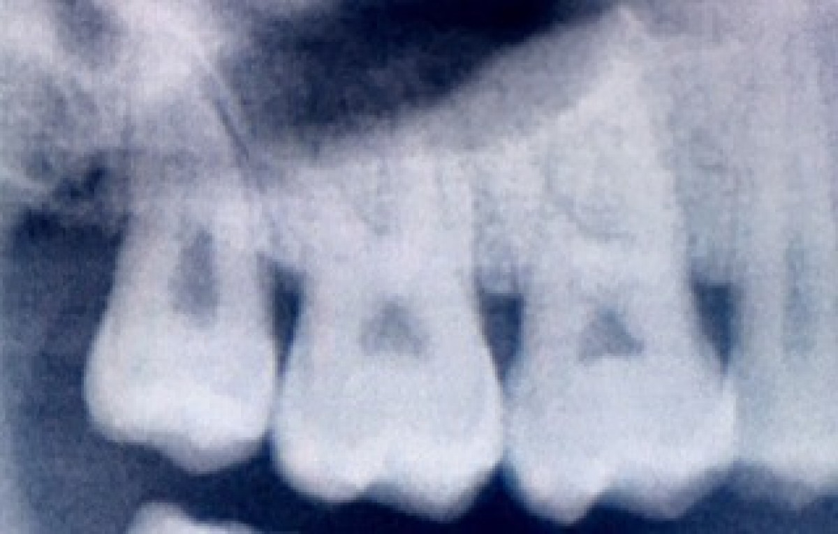 Maxillary Third Molar Extraction: Two Techniques Compared | Dentistry33