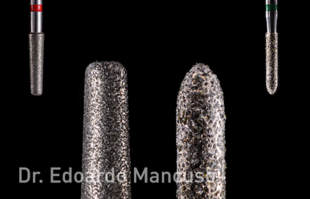 Ceramic crowns and their finishing line: a systematic review | Dentistry33