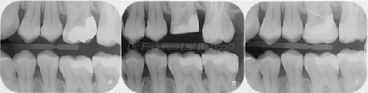 Cervical Margin Relocation: flowable or traditional hybrid composite ...