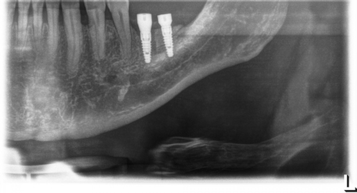 Personalized bone graft in severe mandibular atrophy. | Dentistry33