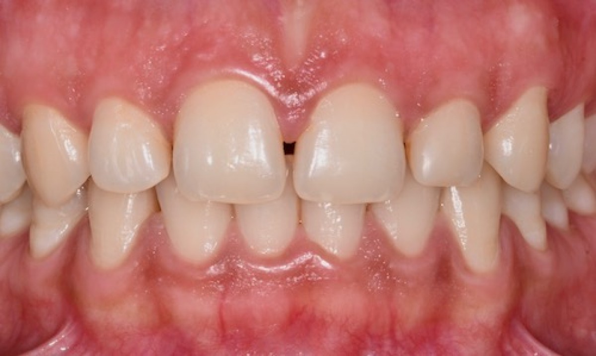 The effect of the gingival phenotype on periodontal health | Dentistry33
