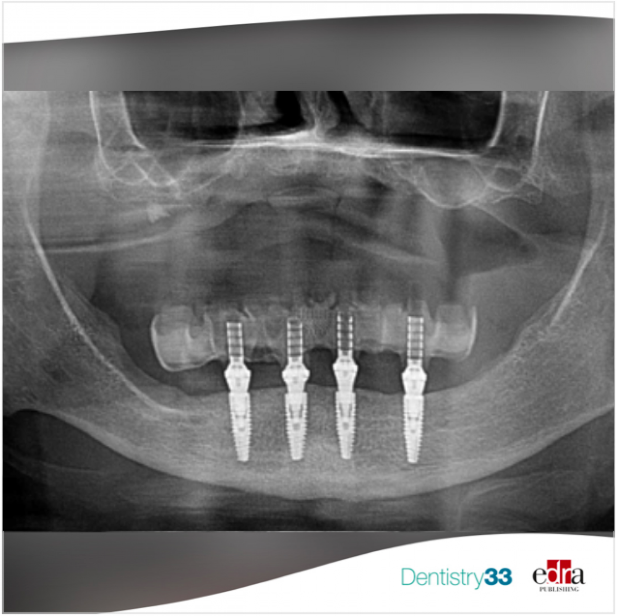 Immediate loading implants with one step technique and double milling ...