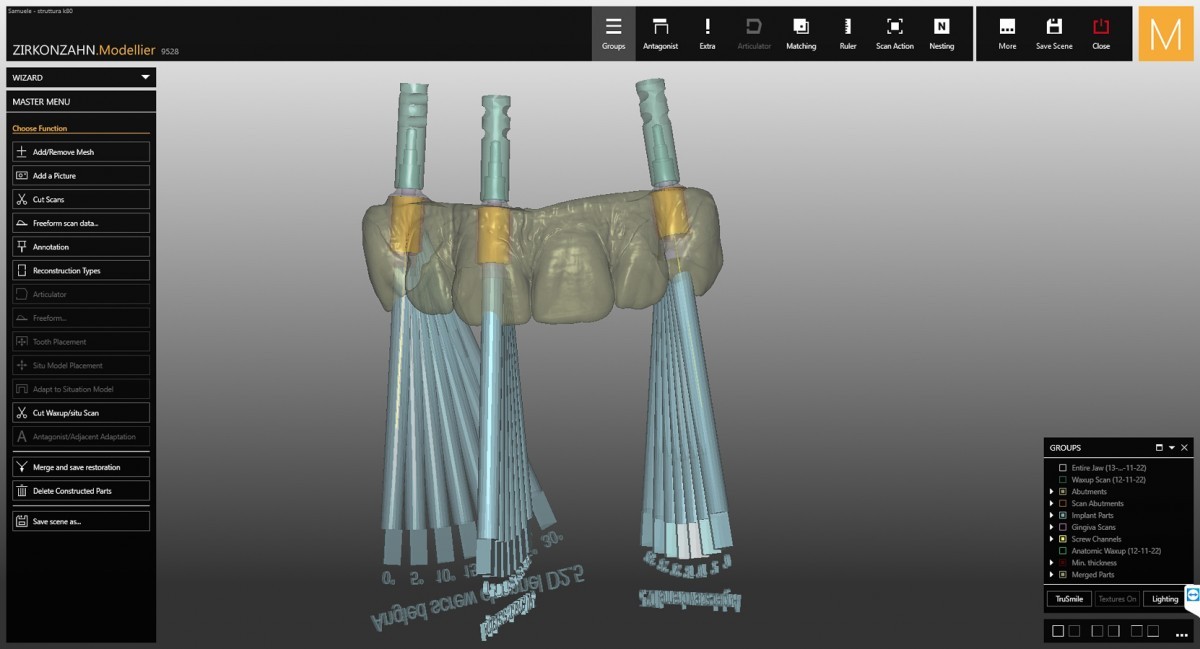 Four solutions to correct divergent implants | Dentistry33