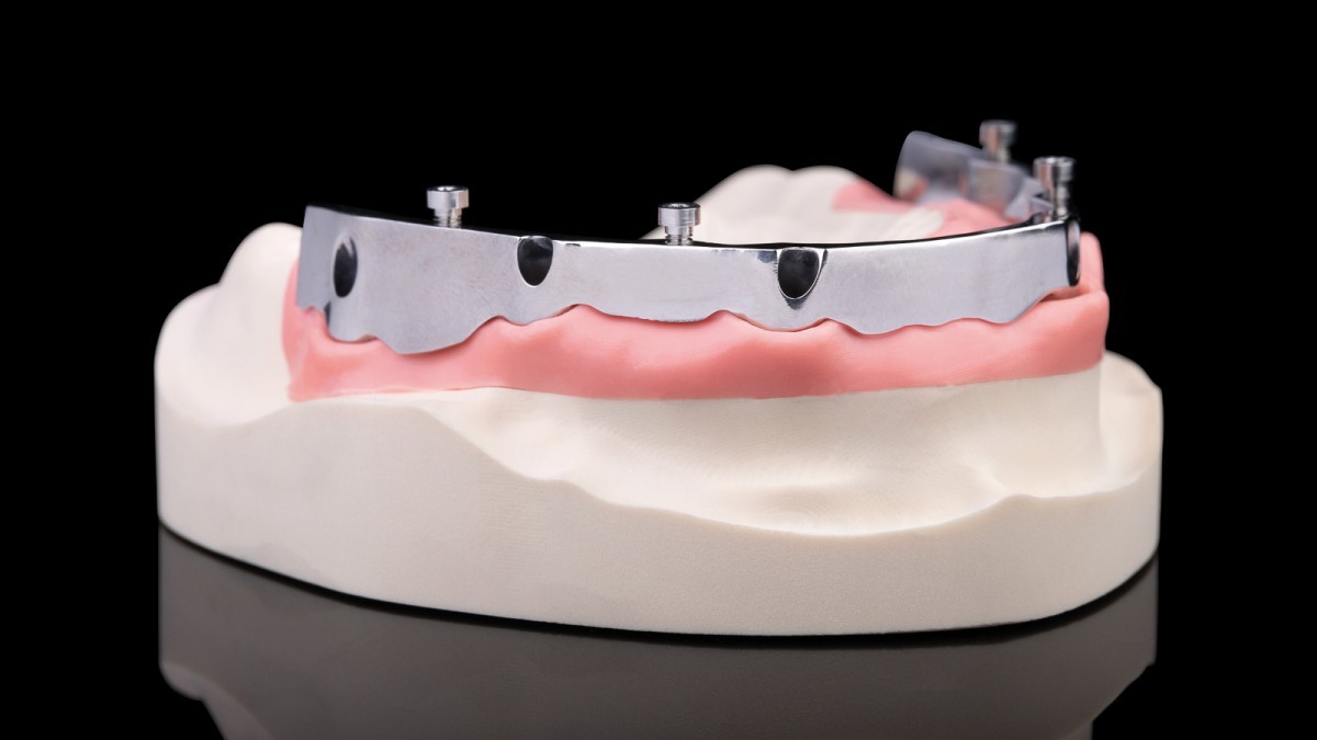 Four solutions to correct divergent implants | Dentistry33