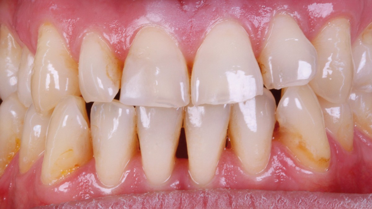 Minimally invasive restoration with ultrathin veneers and posterior ...