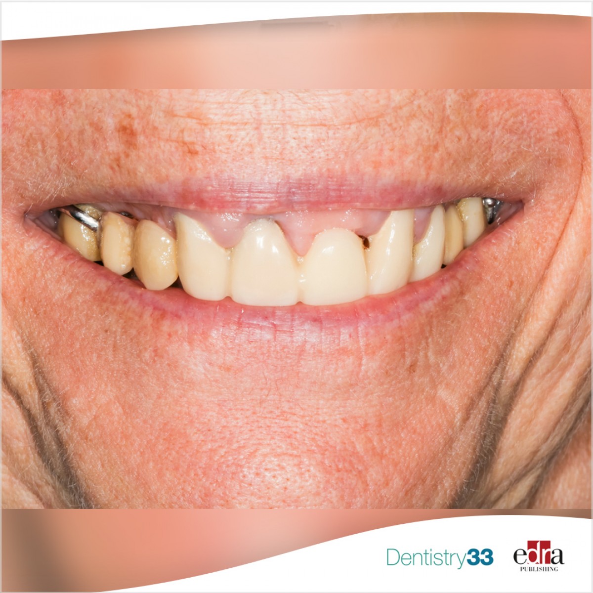 Using Online Videos To Obtain Information About Peri implantitis using-online-videos-to-obtain-information-about-peri-implantitis
