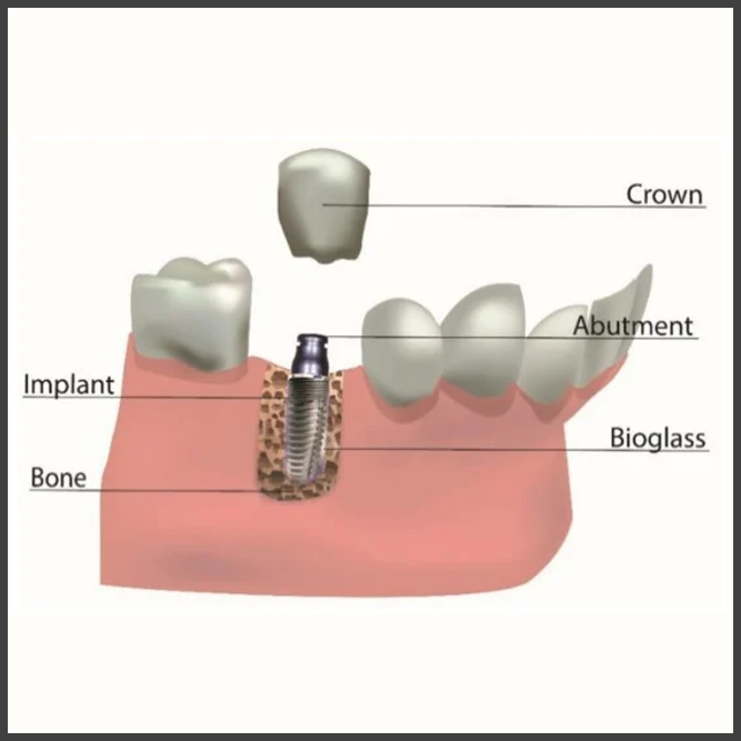 Latest Trends in Surface Modification for Dental Implantology ...