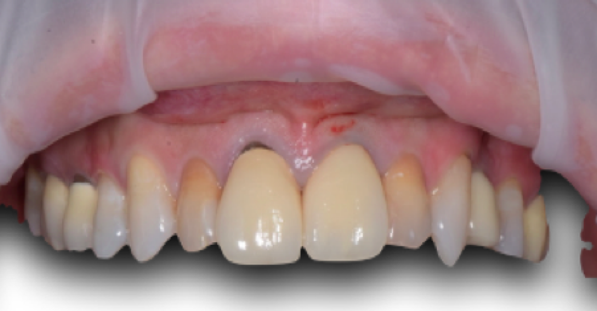 Immediate loading post-extraction implants on upper central incisors ...