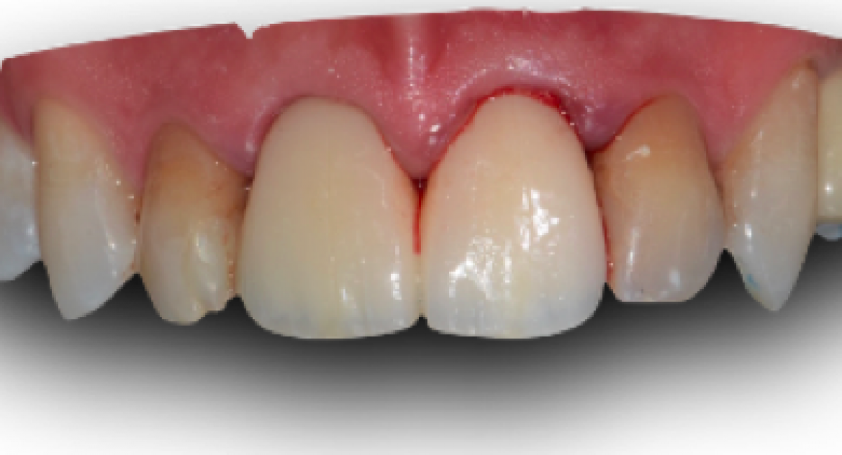 Immediate loading post-extraction implants on upper central incisors ...